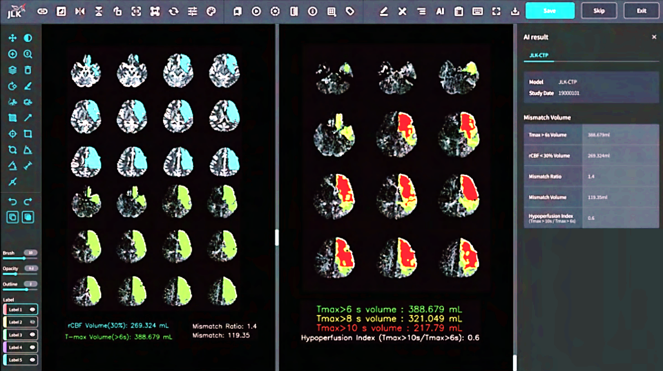 제이엘케이, FDA에 뇌 관류 CT 영상 분석 솔루션 ‘JLK-CTP’ 인허가 신청