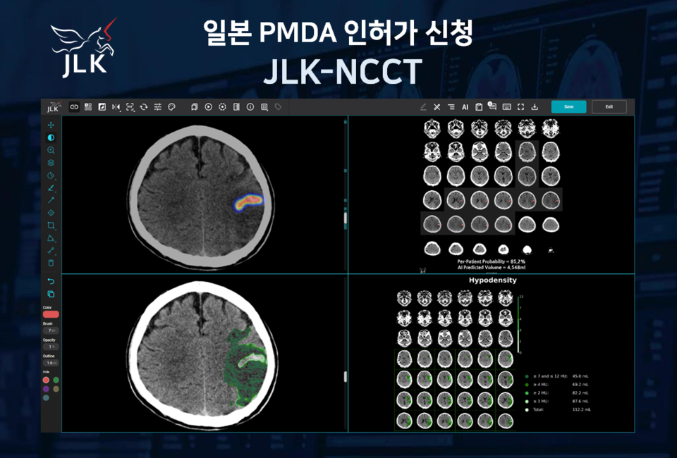 제이엘케이, 비조영 CT 기반 뇌졸중 AI 솔루션 'JLK-NCCT' 日 PMDA 신청